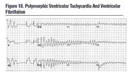 Ventricular Tachycardia Vs Supraventricular Tachycardia